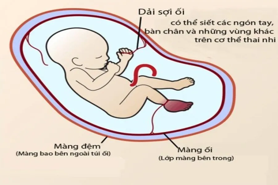 Kỹ Thuật Nội Soi Buồng Ối Điều Trị Hội Chứng Dải Sợi Ối Bằng Laser: Quy ...