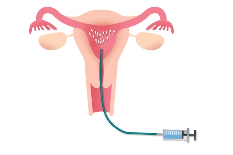 IUI Là Gì? Quy Trình Bơm IUI Và Bí Quyết Tăng Tỷ Lệ Thụ Tinh Nhân Tạo ...